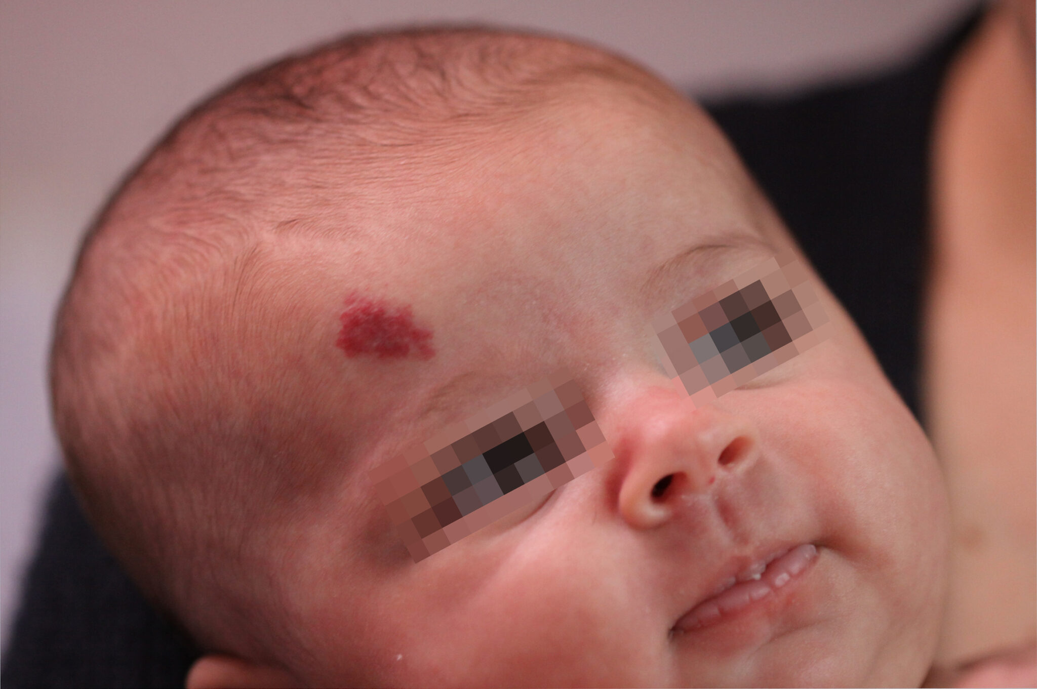 Infantile Hämangiome: Blutschwämmchen bei Kleinkindern